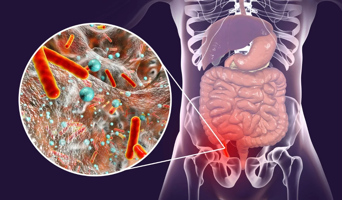 Appendectomy Cost in Bangladesh | Guide by BHA